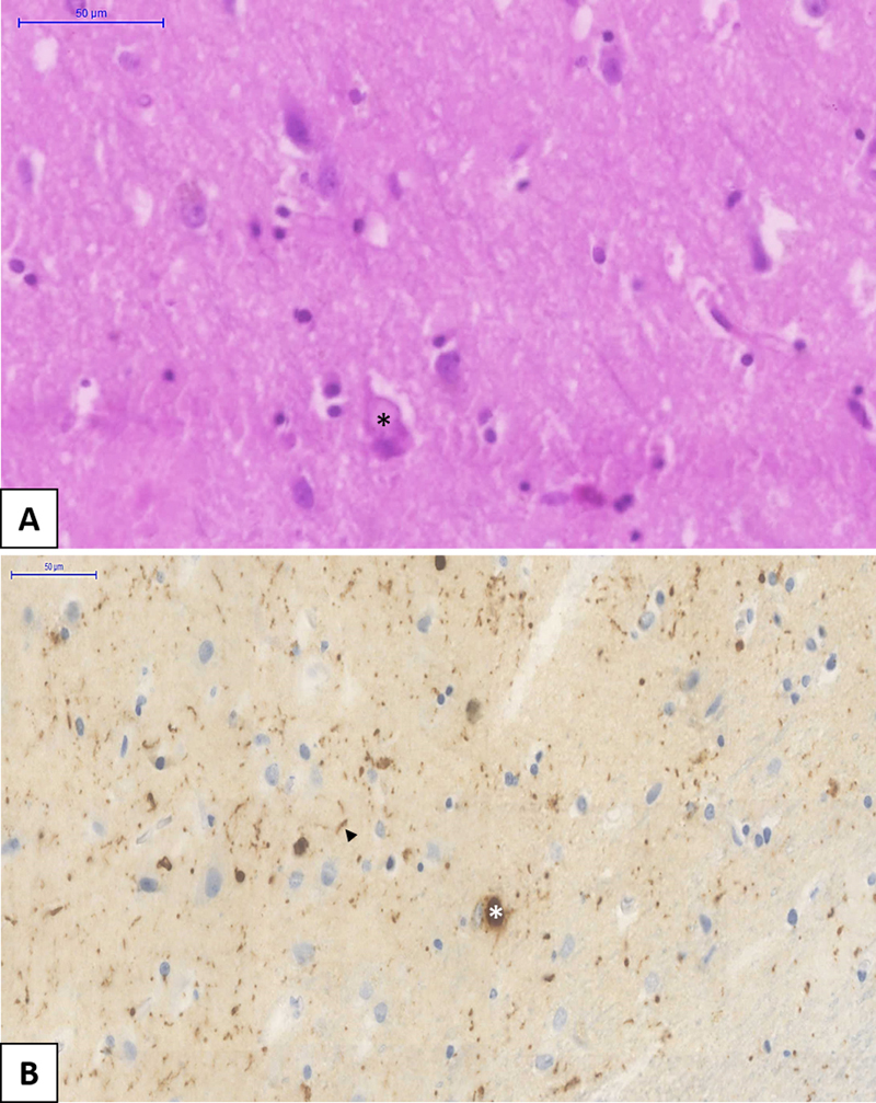 Dementia with Lewy bodies – a clinicopathological update