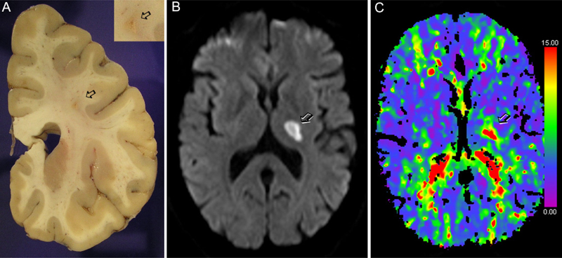 Top ten discoveries of the year: Neurovascular disease