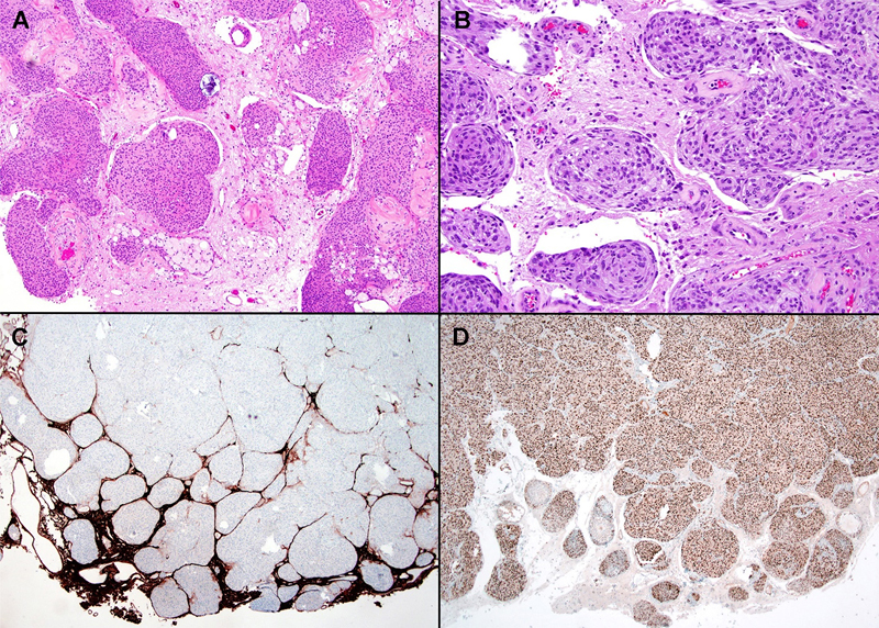 The definition and role of brain invasion in meningioma grading: Still ...