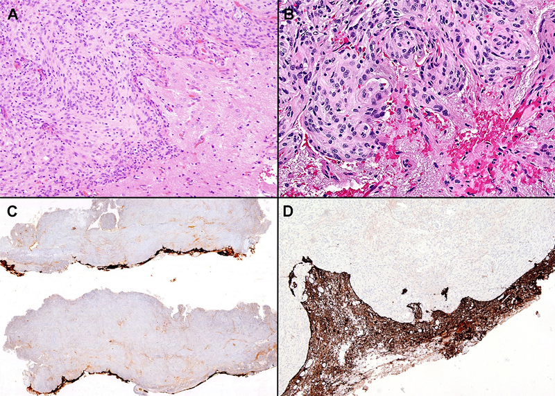 The definition and role of brain invasion in meningioma grading: Still ...