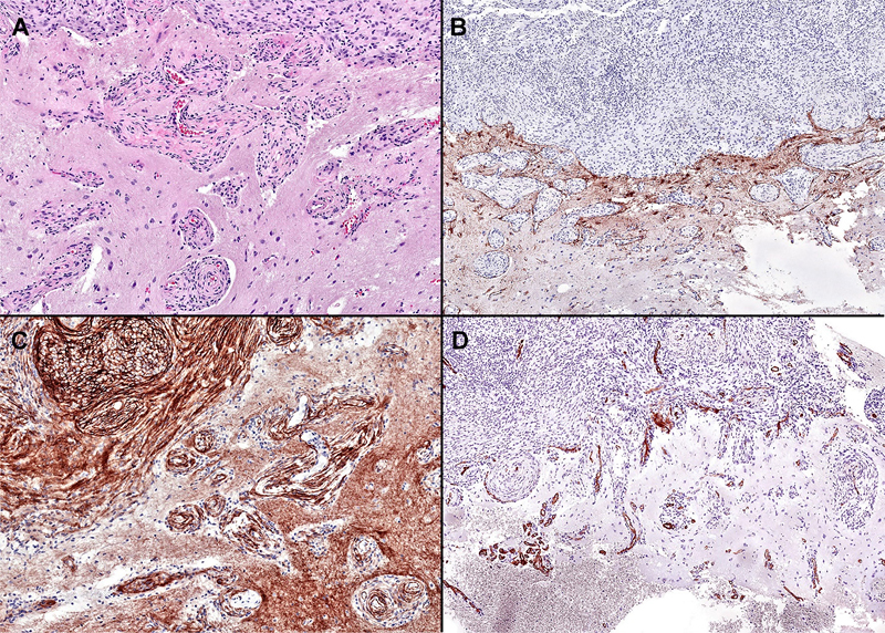 The definition and role of brain invasion in meningioma grading: Still ...