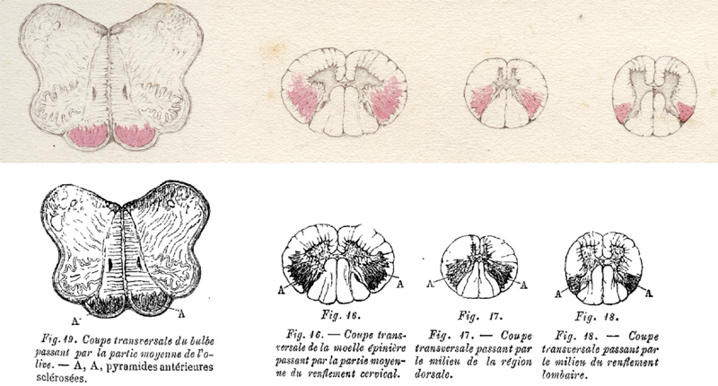 Charcot identifies and illustrates amyotrophic lateral sclerosis