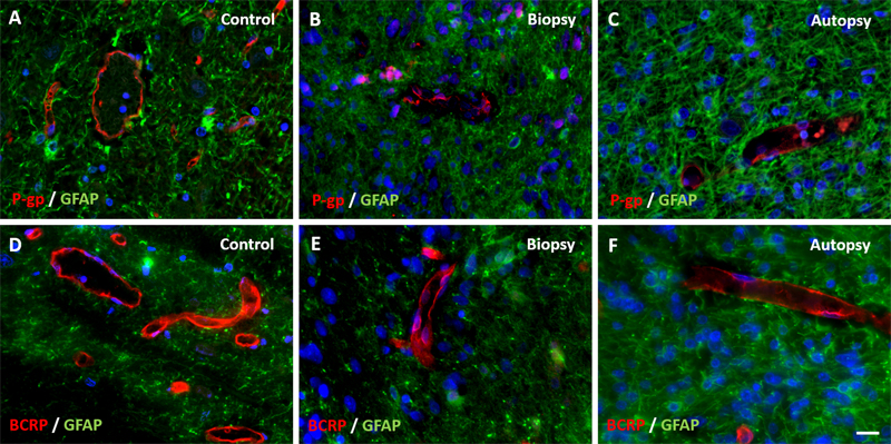 The neurovascular unit in diffuse intrinsic pontine gliomas
