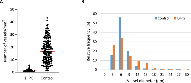 The neurovascular unit in diffuse intrinsic pontine gliomas