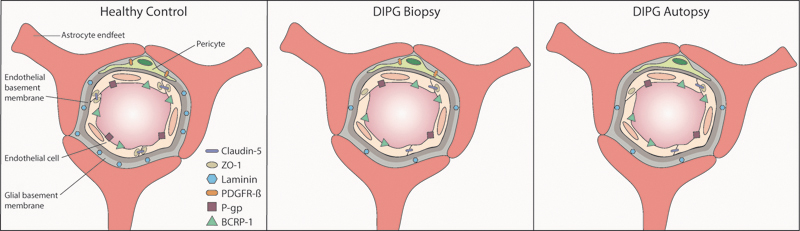The neurovascular unit in diffuse intrinsic pontine gliomas