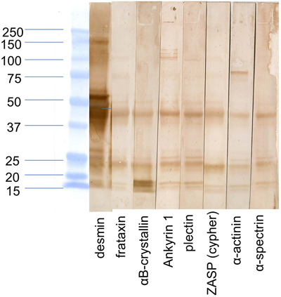 Friedreich cardiomyopathy is a desminopathy