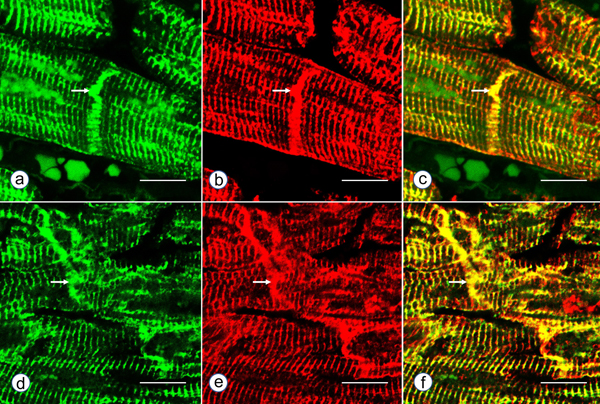 Friedreich cardiomyopathy is a desminopathy
