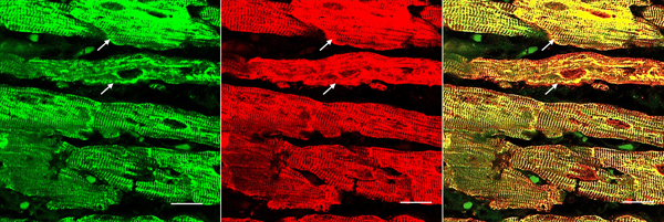 Friedreich cardiomyopathy is a desminopathy