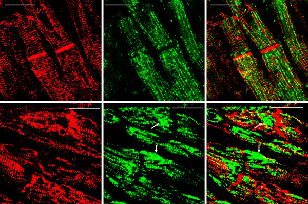 Friedreich cardiomyopathy is a desminopathy