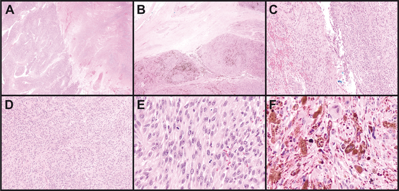 Malignant melanotic nerve sheath tumor with PRKAR1A, KMT2C and GNAQ ...