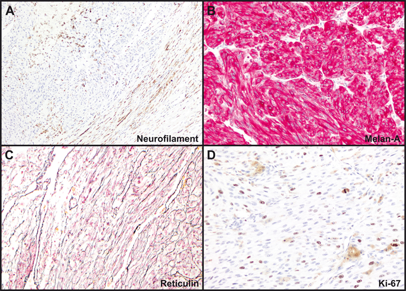 Malignant melanotic nerve sheath tumor with PRKAR1A, KMT2C and GNAQ ...